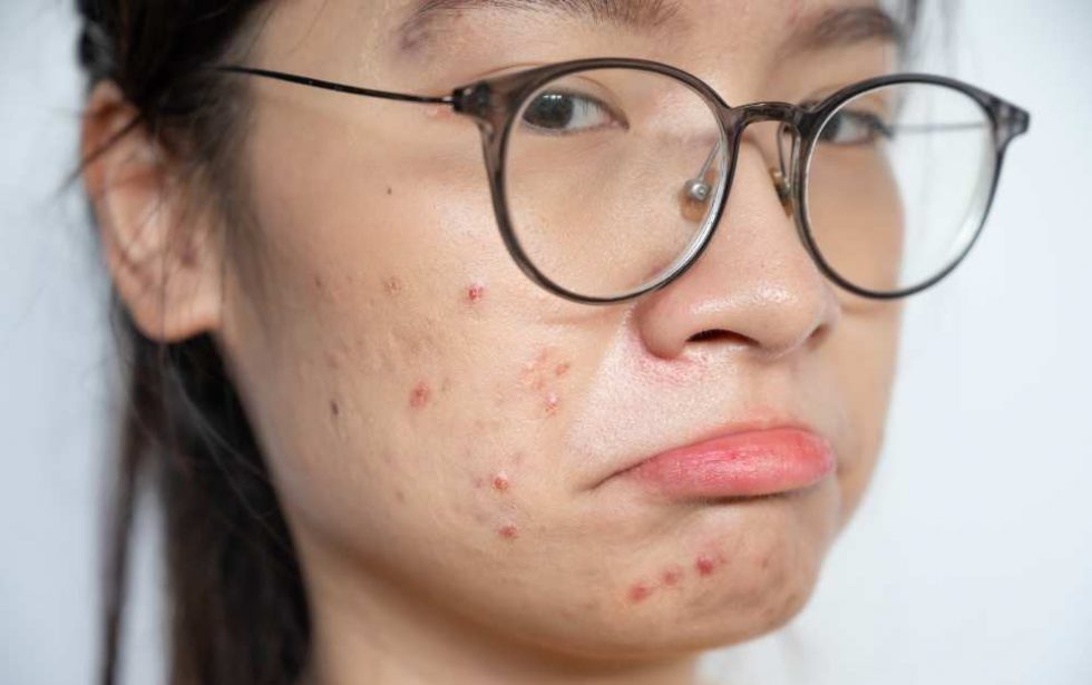 7 Cara Menghilangkan Jerawat Papula yang Efektif - Eterniskin